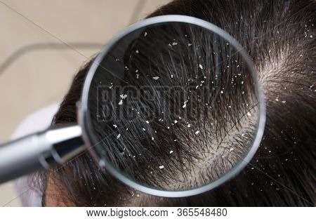 Closeup Woman Dandruff Image & Photo (Free Trial) | Bigstock