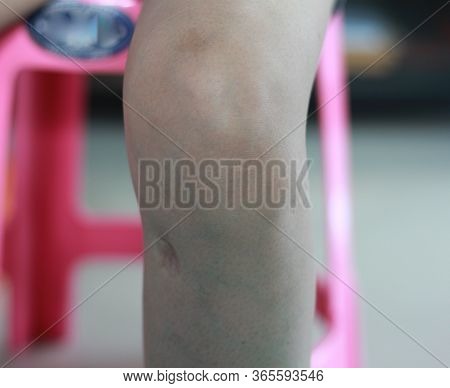 Scars On Skin Around Image & Photo (Free Trial) | Bigstock