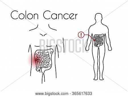 Colon Cancer Linear Vector & Photo (Free Trial) | Bigstock
