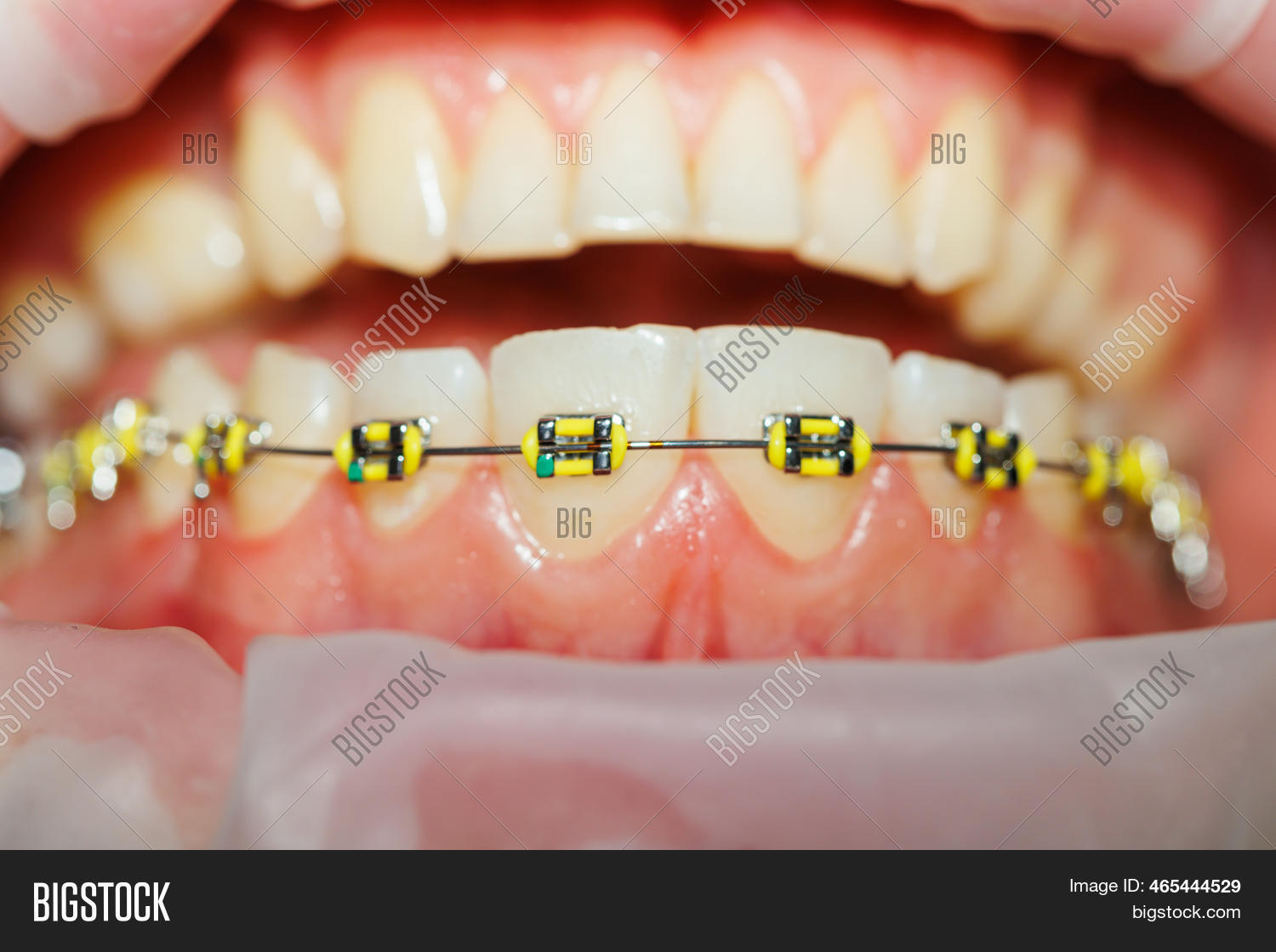 Extender Teeth. Teeth Image & Photo (Free Trial) | Bigstock