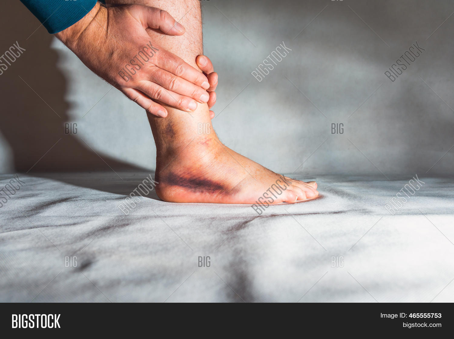 Sprained Swollen Ankle Image & Photo (Free Trial) | Bigstock
