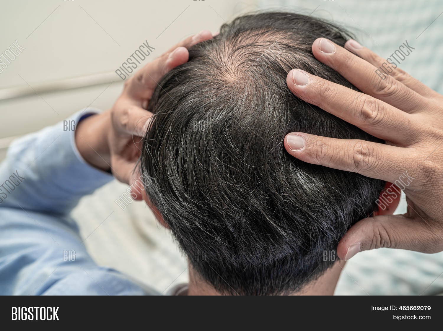 Bald Middle Head Begin Image & Photo (Free Trial) | Bigstock