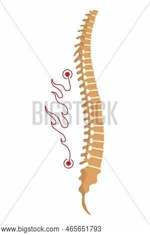 Spinal Deformity. Vector & Photo (Free Trial) | Bigstock