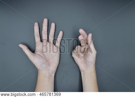 Unilateral Dupuytren's Image & Photo (Free Trial) | Bigstock