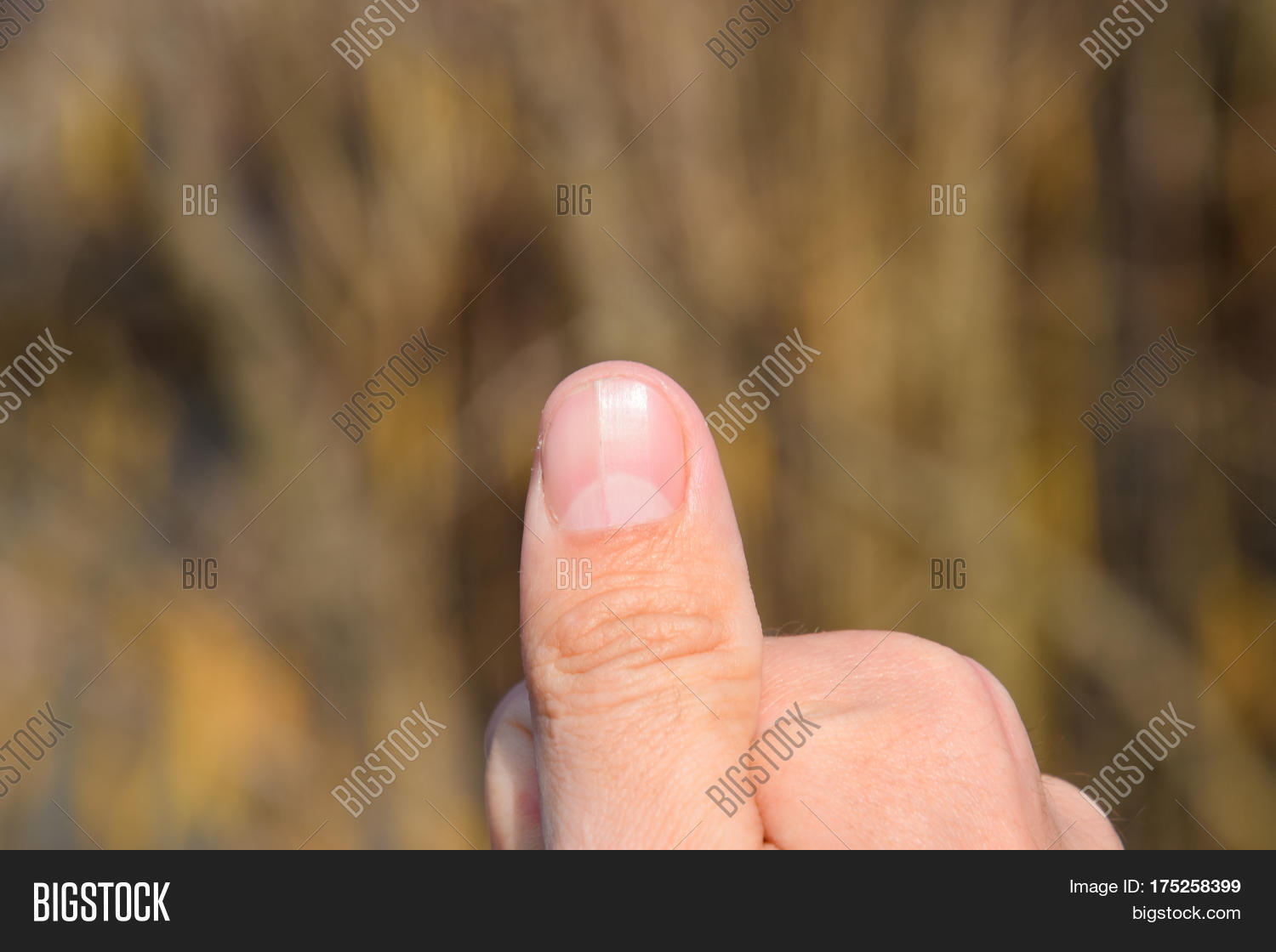 Forked Nail On Thumb. Image & Photo (Free Trial) | Bigstock