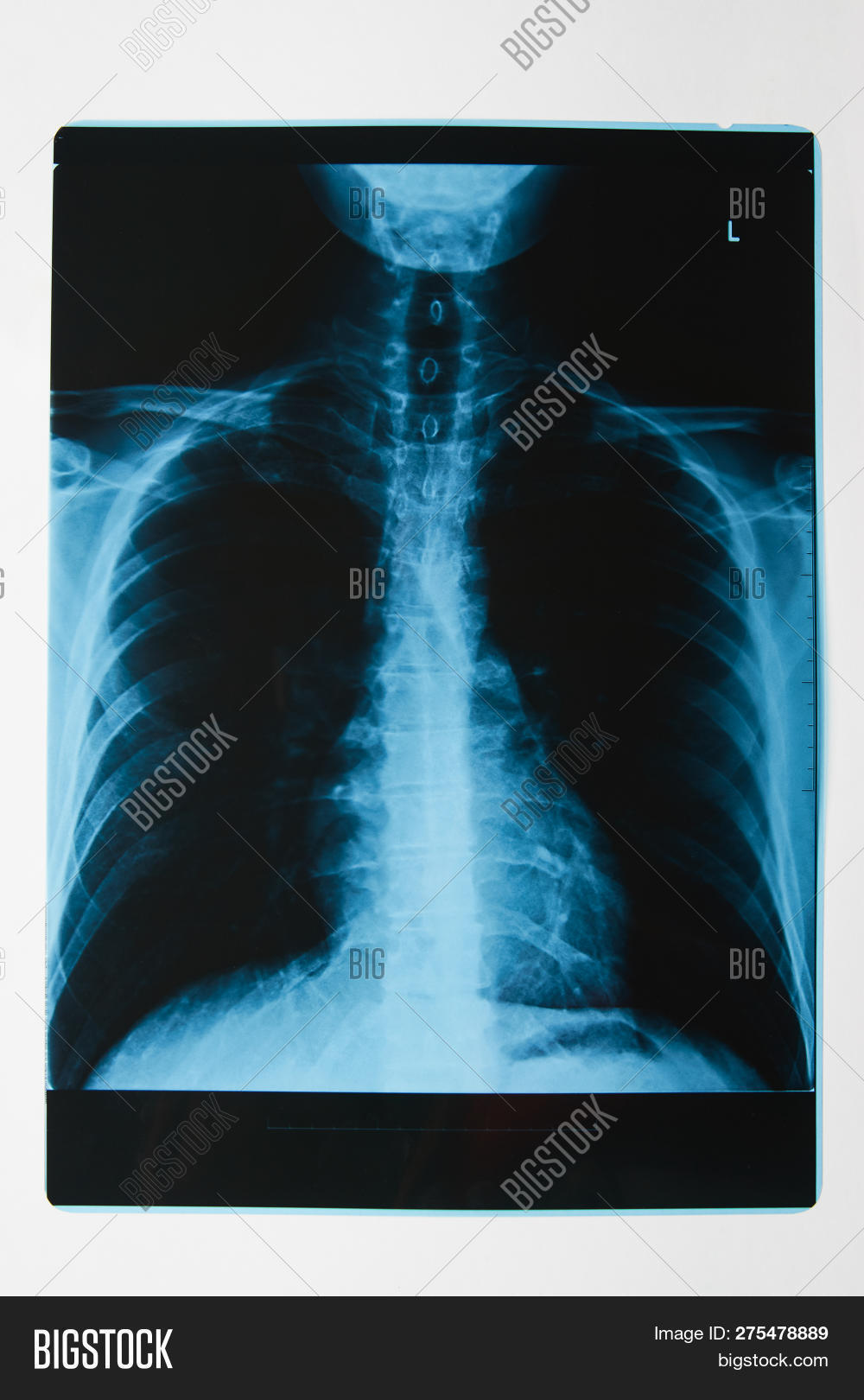 X-ray Thorax, Close-. Image & Photo (Free Trial) | Bigstock