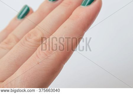 Scar On Finger Man On Image & Photo (Free Trial) | Bigstock