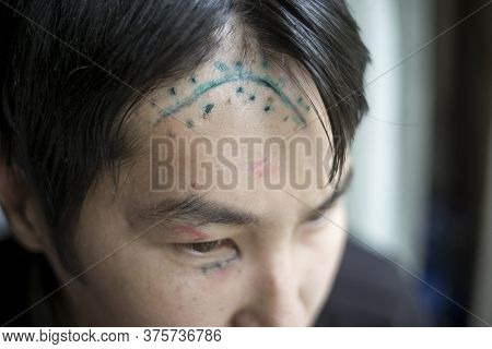 Scar On Head Young Guy Image & Photo (Free Trial) | Bigstock