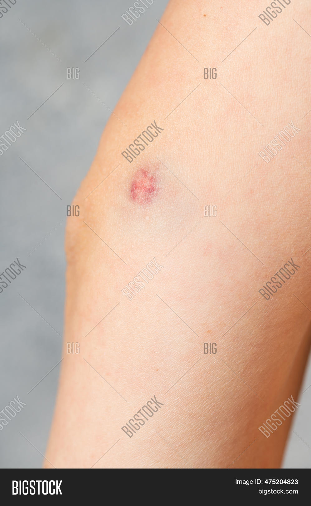 Big Bruise On Girls Image & Photo (Free Trial) | Bigstock