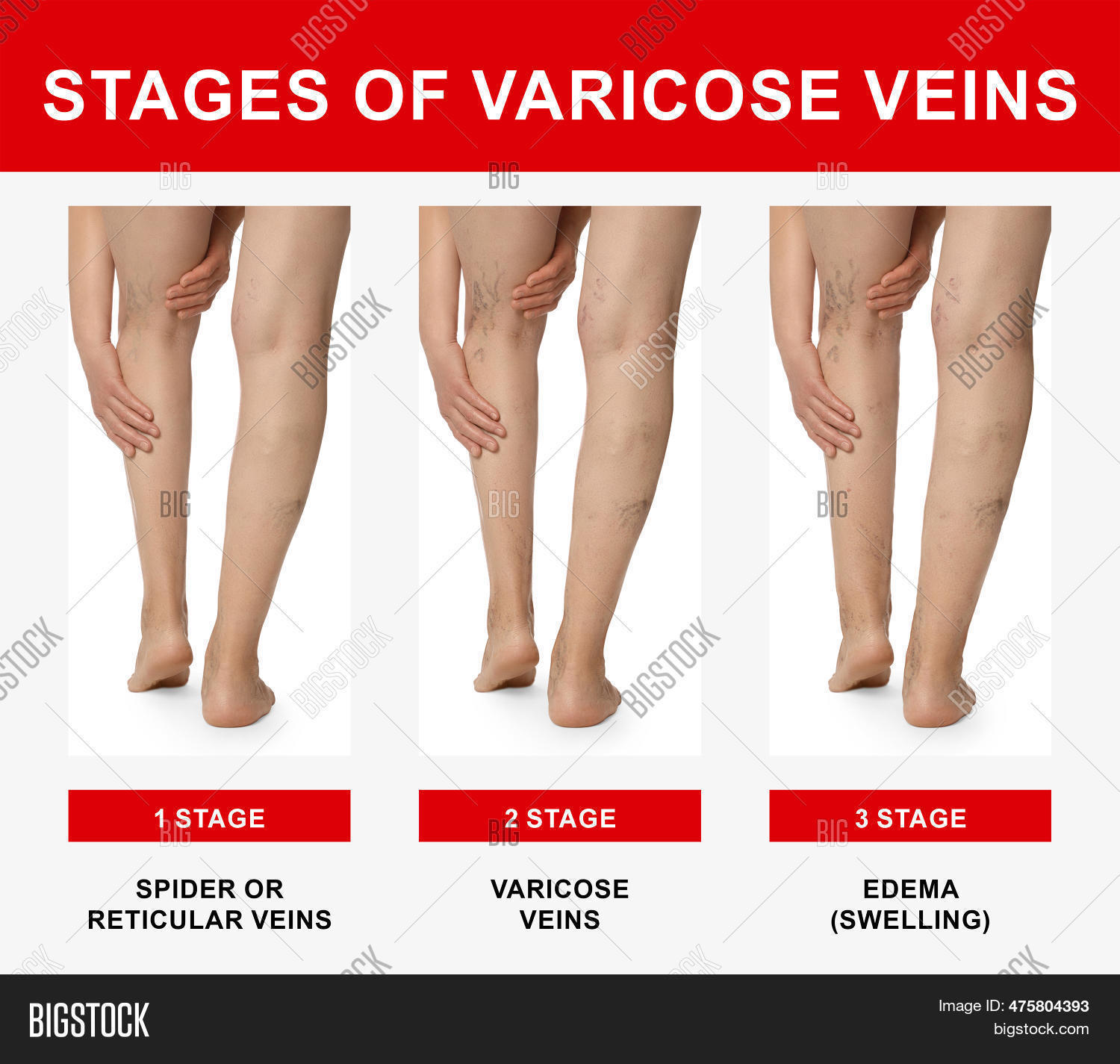 Stages Varicose Veins Image & Photo (Free Trial) | Bigstock