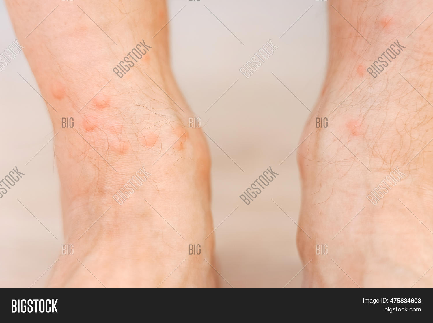 Close Allergic Rash Image & Photo (Free Trial) | Bigstock