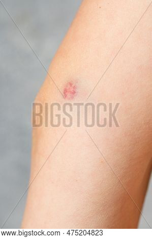 Big Bruise On Girls Image & Photo (Free Trial) | Bigstock