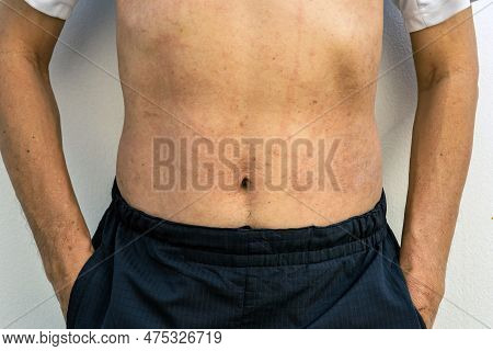 Itchy Body Rash Caused Image & Photo (Free Trial) | Bigstock