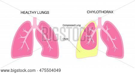 Chylothorax Disease. Vector & Photo (Free Trial) | Bigstock