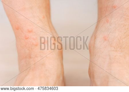 Close Allergic Rash Image & Photo (Free Trial) | Bigstock