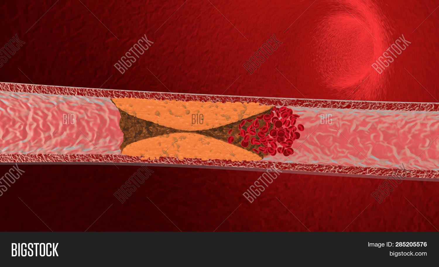 Blocked Blood Vessel. Image & Photo (Free Trial) | Bigstock