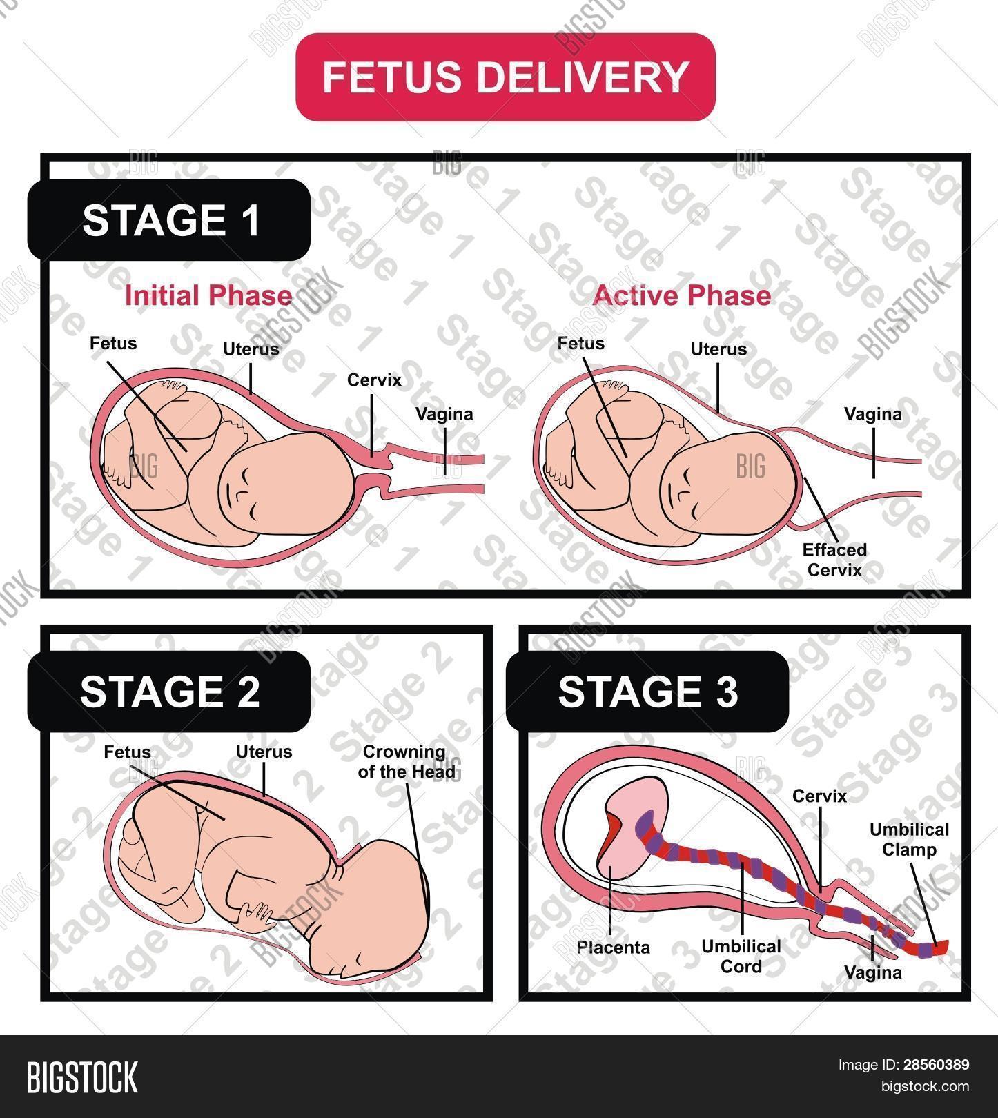 Fetus Delivery - Image & Photo (Free Trial) | Bigstock