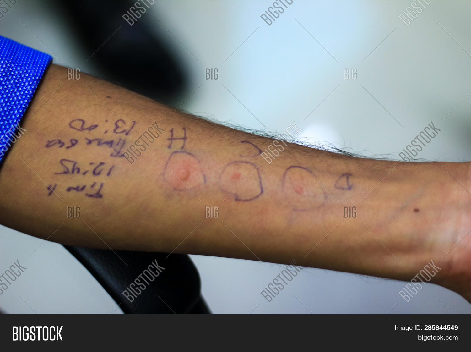 Skin Allergy Test Image & Photo (Free Trial) | Bigstock