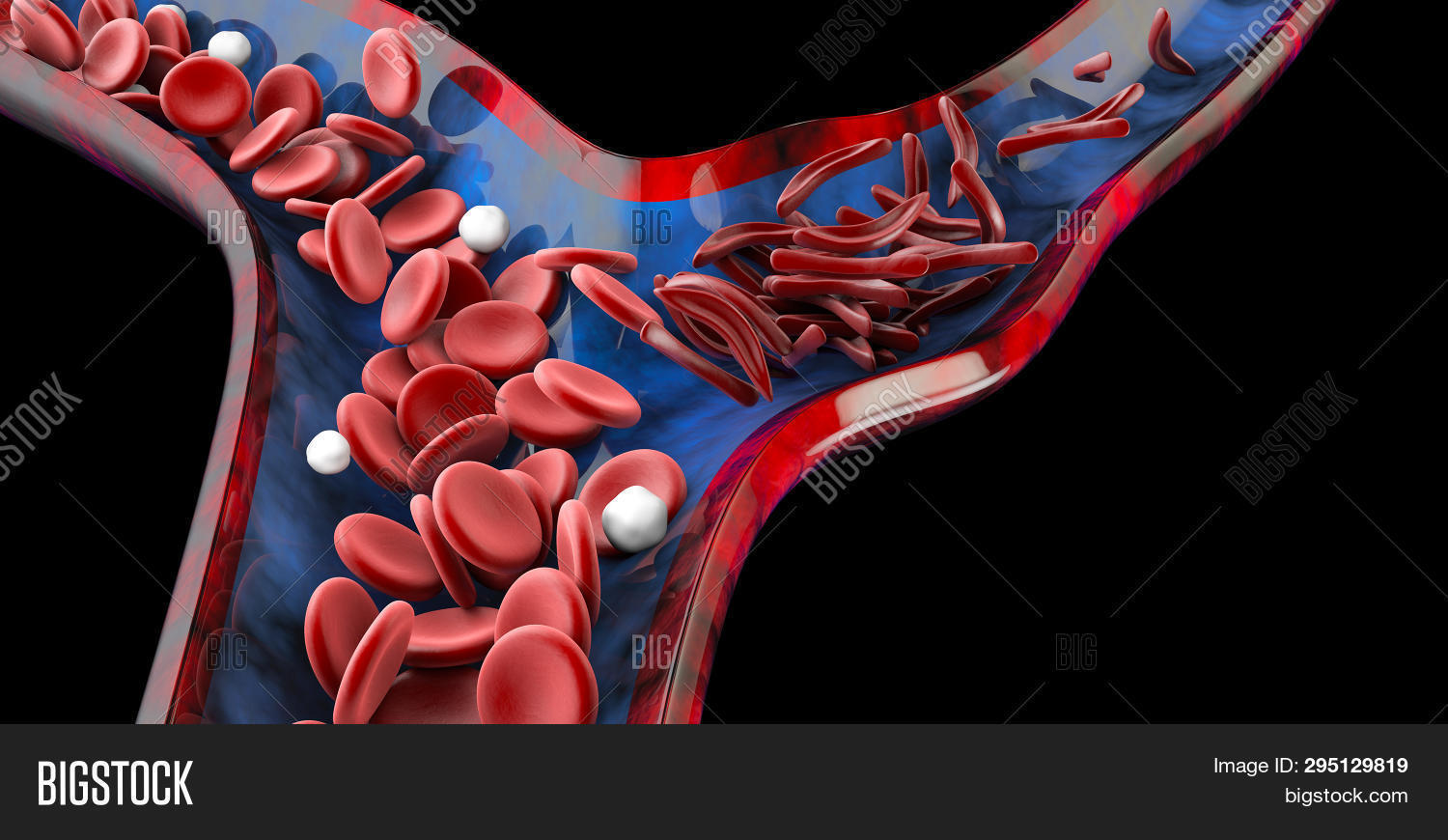 Sickle Cell Anemia, Image & Photo (Free Trial) | Bigstock