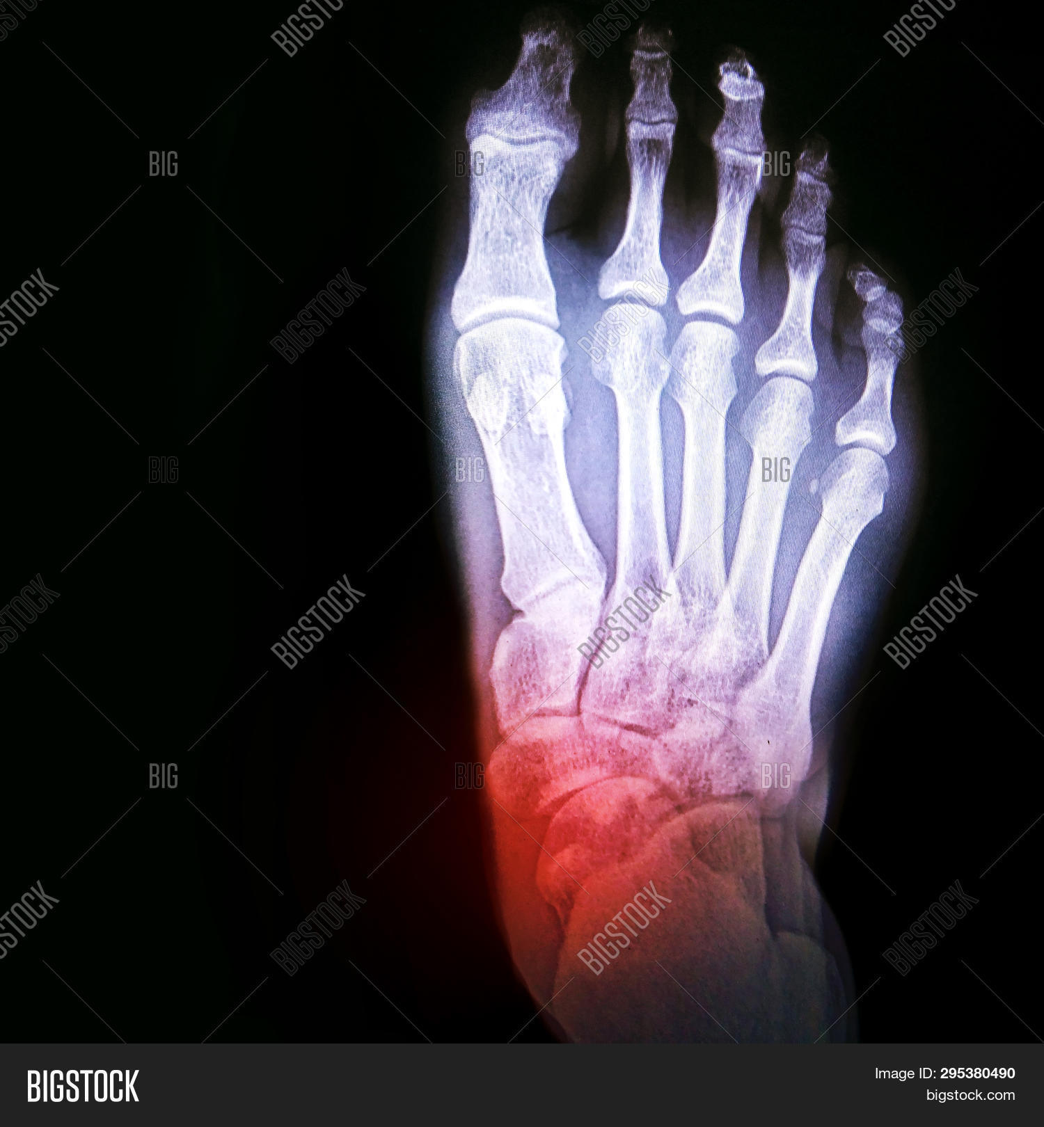 Dislocation Ankle Image & Photo (Free Trial) | Bigstock