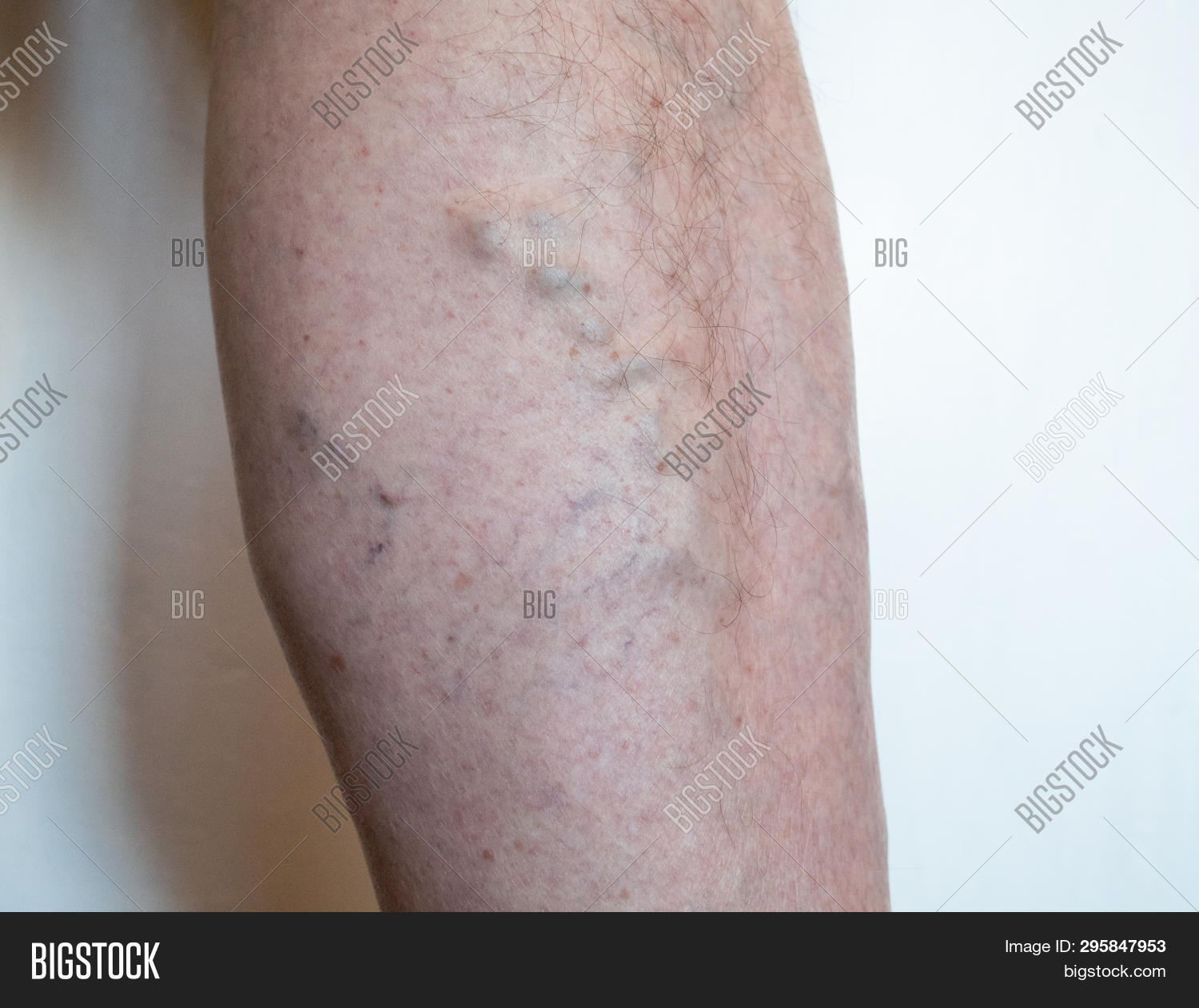 Leg Old Man Varicose Image & Photo (Free Trial) | Bigstock