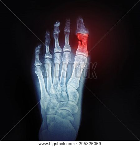 Broken Toe. X-ray Foot Image & Photo (Free Trial) | Bigstock