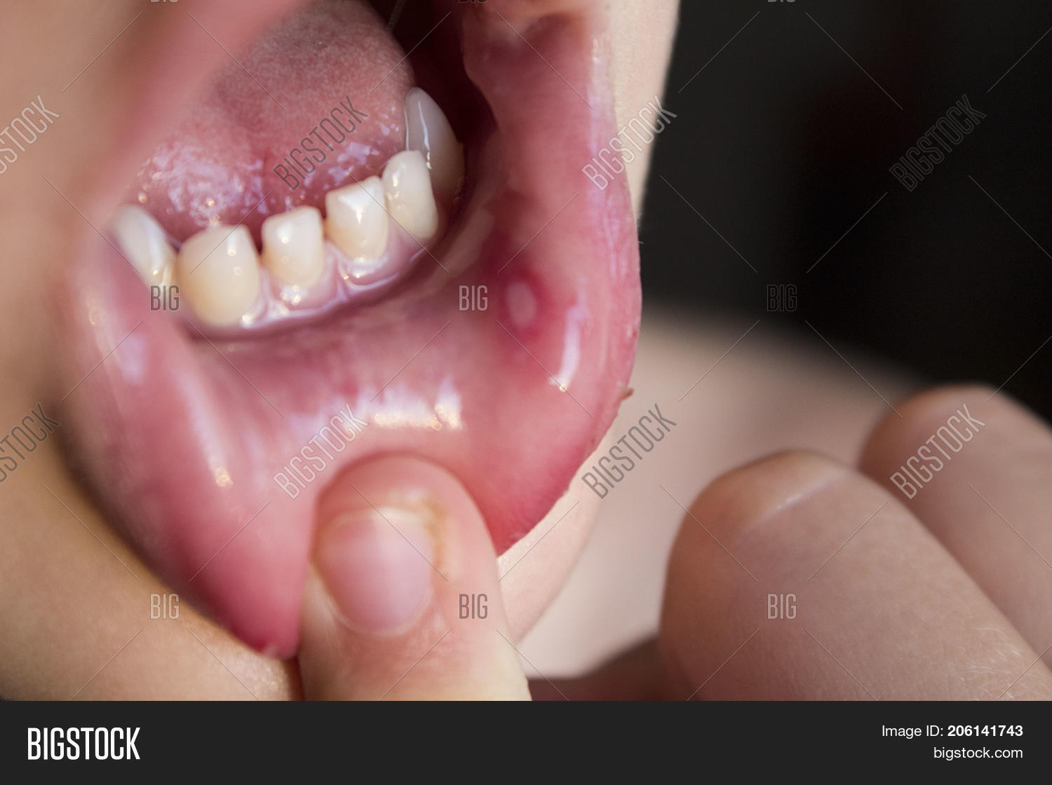Children Aphtha On Lip Image & Photo (Free Trial) | Bigstock