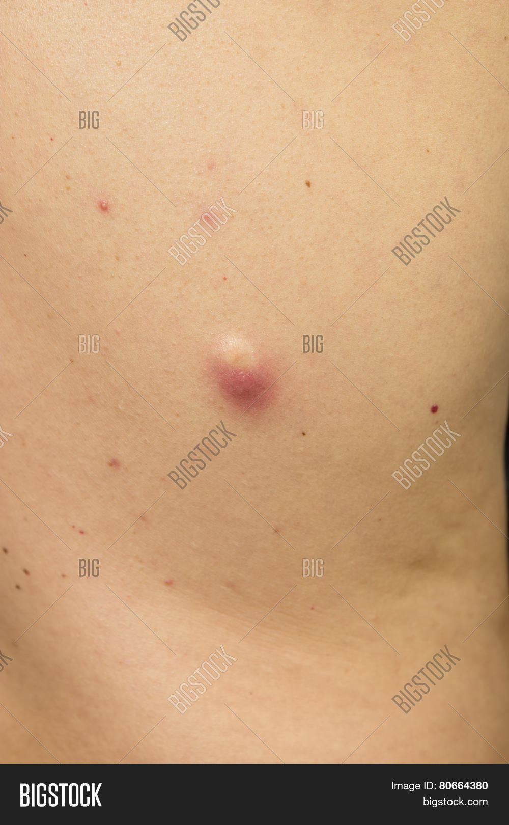 Infected Sebaceous Image & Photo (Free Trial) | Bigstock