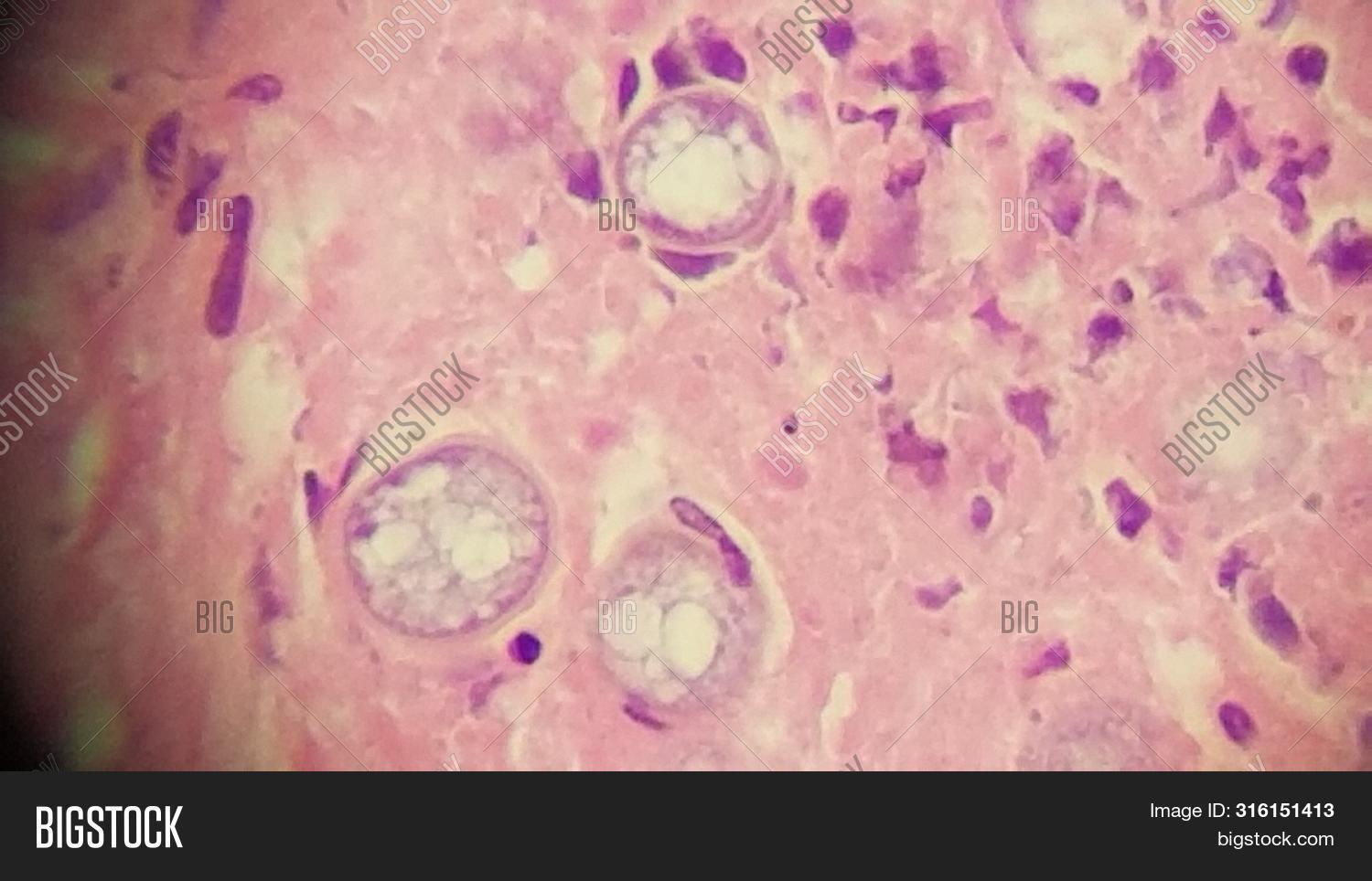 Coccidioides Imitis Image & Photo (Free Trial) | Bigstock