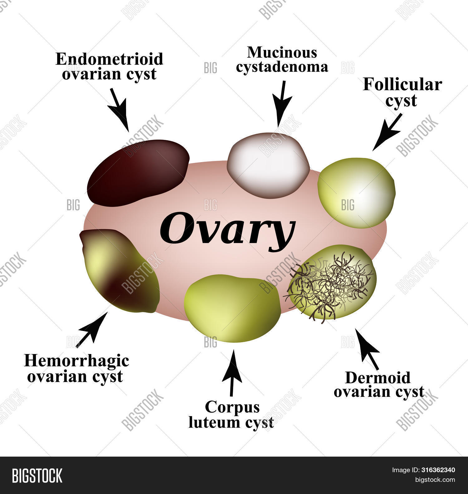 Types Ovarian Cysts. Image & Photo (Free Trial) | Bigstock
