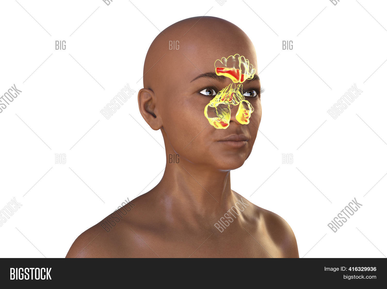 Sinusitis, Image & Photo (Free Trial) | Bigstock