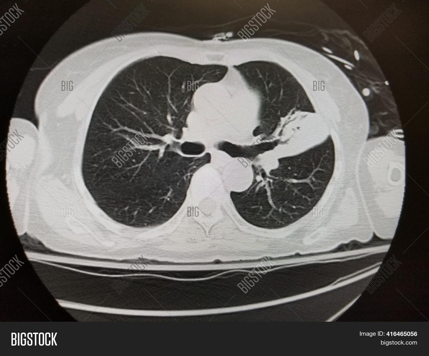Left Upper Lobe Image & Photo (Free Trial) | Bigstock