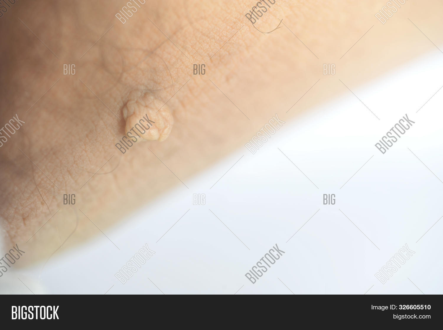 Pedunculated Mass Skin Image & Photo (Free Trial) | Bigstock