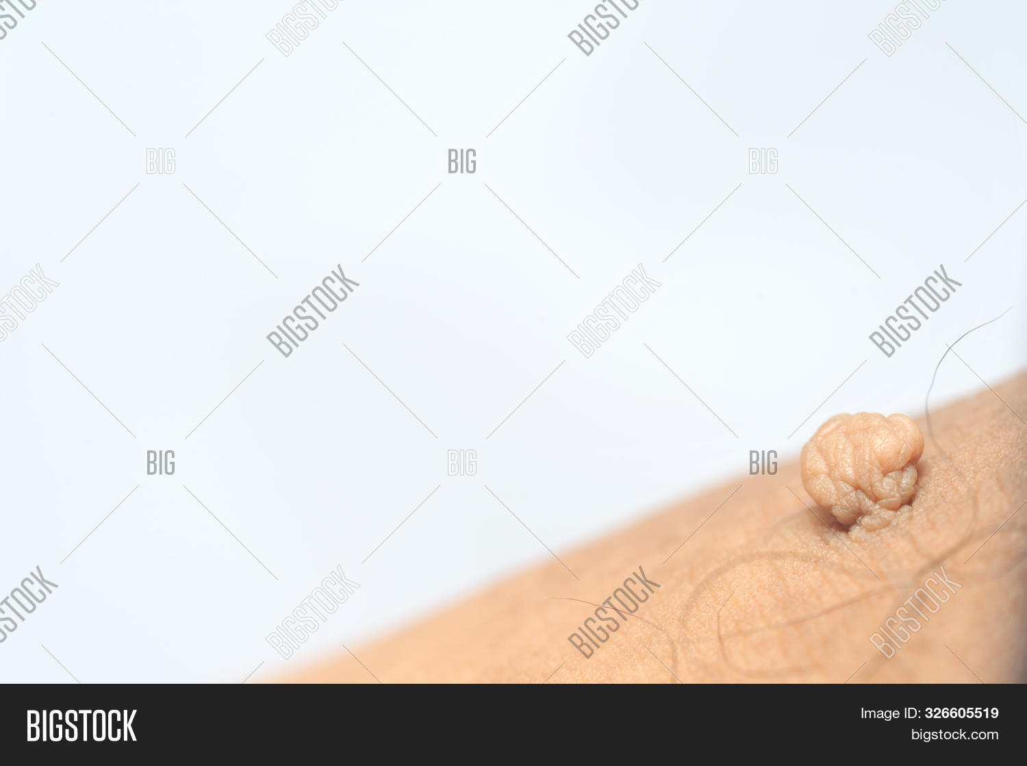 Pedunculated Mass Skin Image & Photo (Free Trial) | Bigstock
