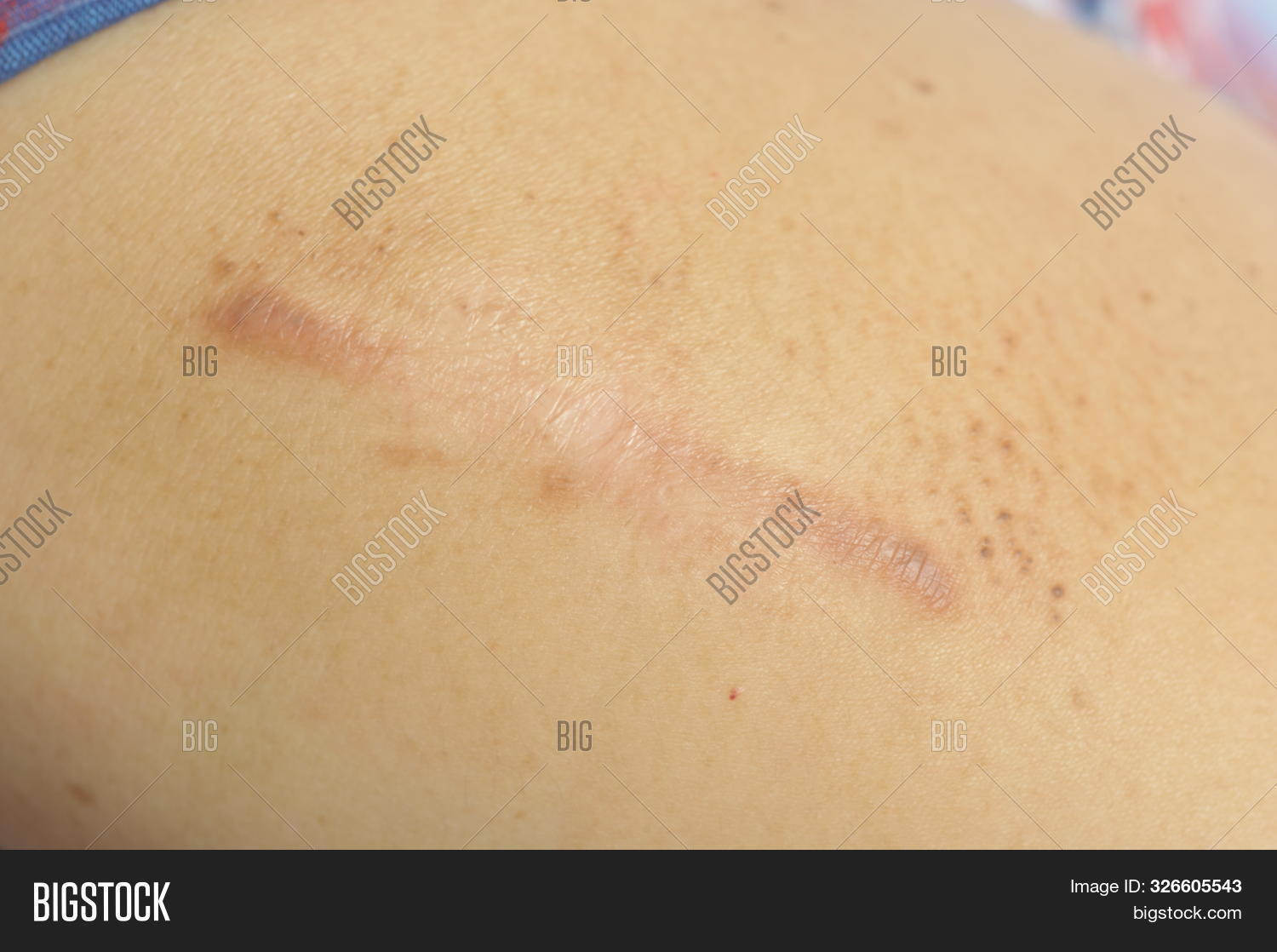 Imagen y foto Scar - Permanent (prueba gratis) | Bigstock