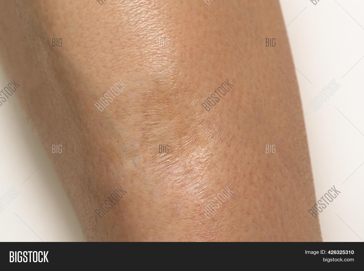 Well Healed Old Scar Image & Photo (Free Trial) | Bigstock