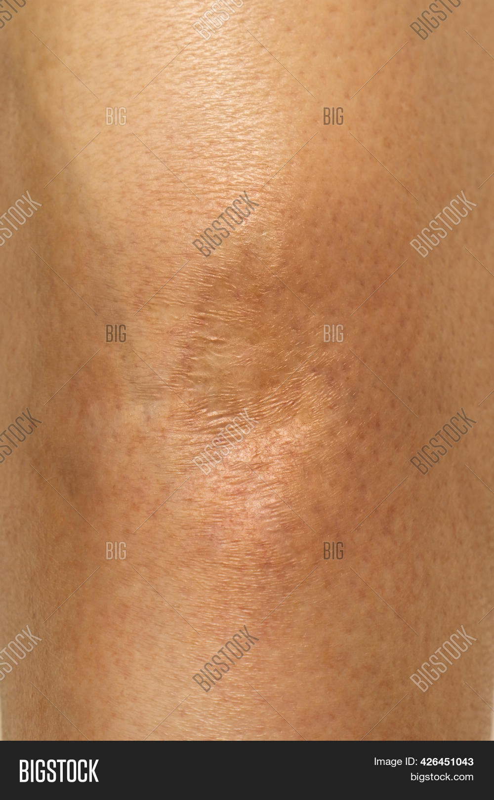 Well Healed Old Scar Image & Photo (Free Trial) | Bigstock