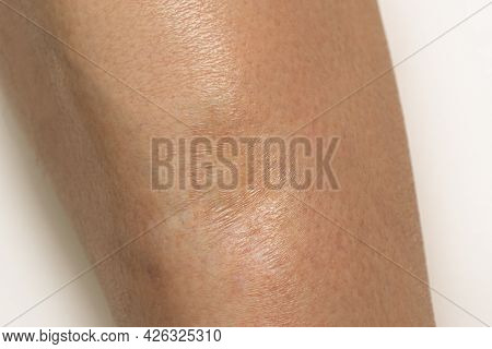 Well Healed Old Scar Image & Photo (Free Trial) | Bigstock