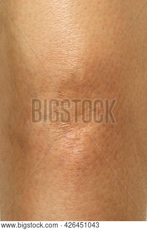 Well Healed Old Scar Image & Photo (Free Trial) | Bigstock