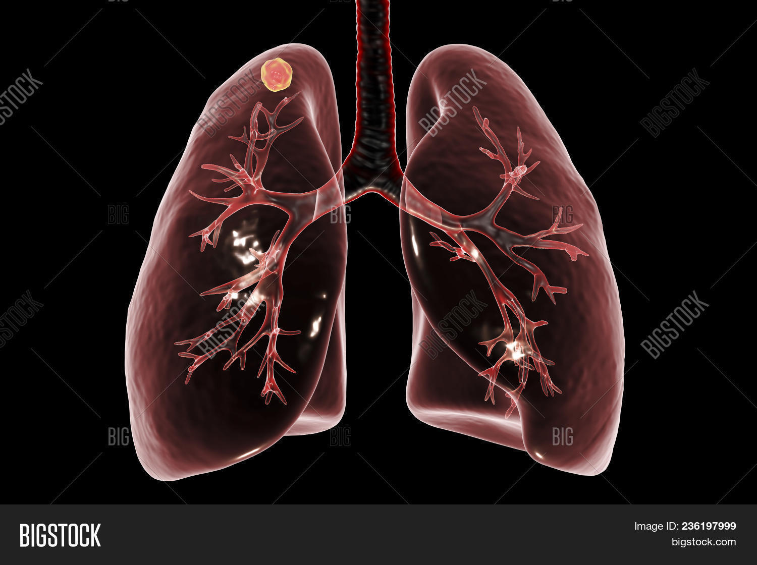 Secondary Tuberculosis Image & Photo (Free Trial) | Bigstock
