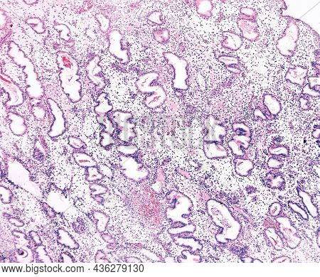Endometrium Advanced Image & Photo (Free Trial) | Bigstock