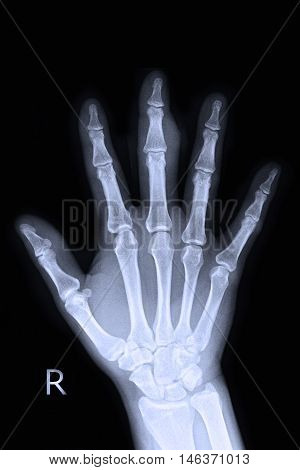 Xray Right Hand Finger Image & Photo (Free Trial) | Bigstock