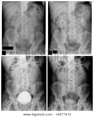 Ivp Pyelogram Patient Image & Photo (Free Trial) | Bigstock