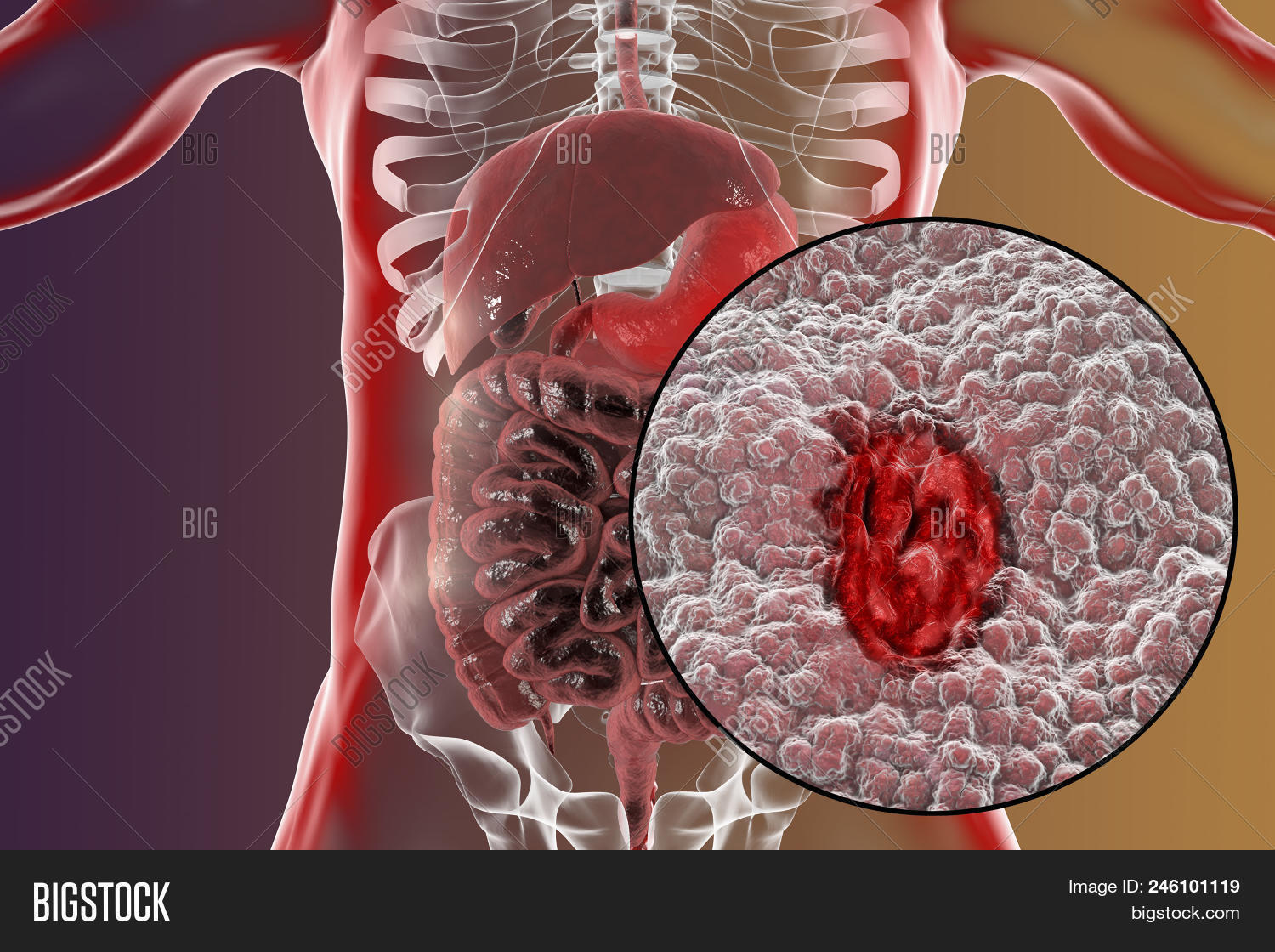 Gastric Ulcer. Mucosa Image & Photo (Free Trial) | Bigstock