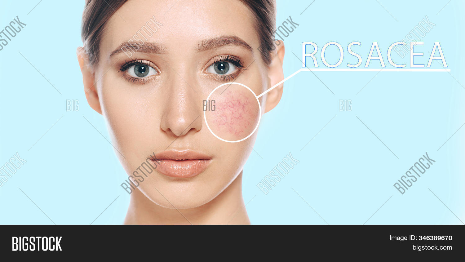 Woman Couperose On Image & Photo (Free Trial) | Bigstock