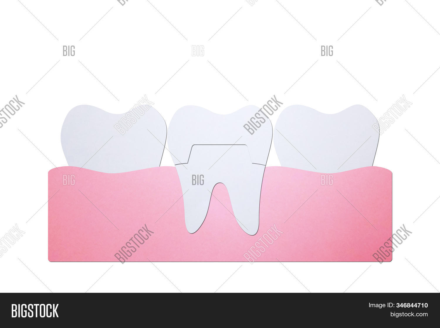 Dental Crown, Image & Photo (Free Trial) | Bigstock