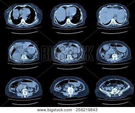 Ct Scan Abdomen By Mri Image & Photo (Free Trial) | Bigstock