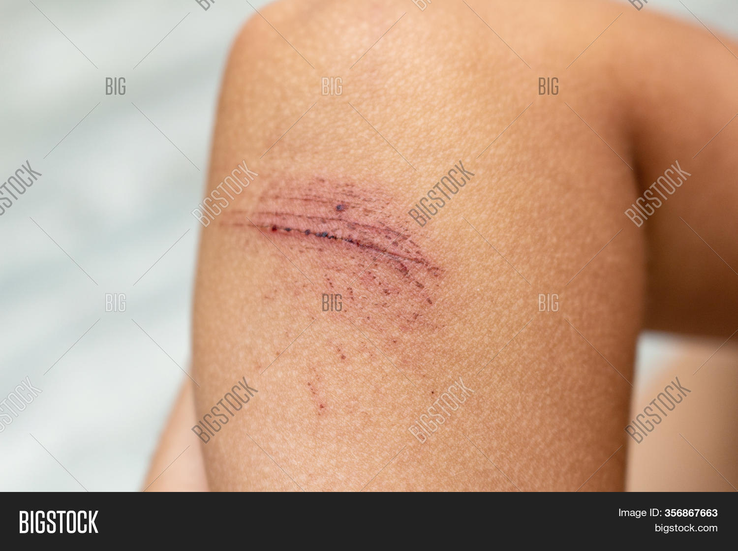Scratch Injury Wound Image & Photo (Free Trial) | Bigstock