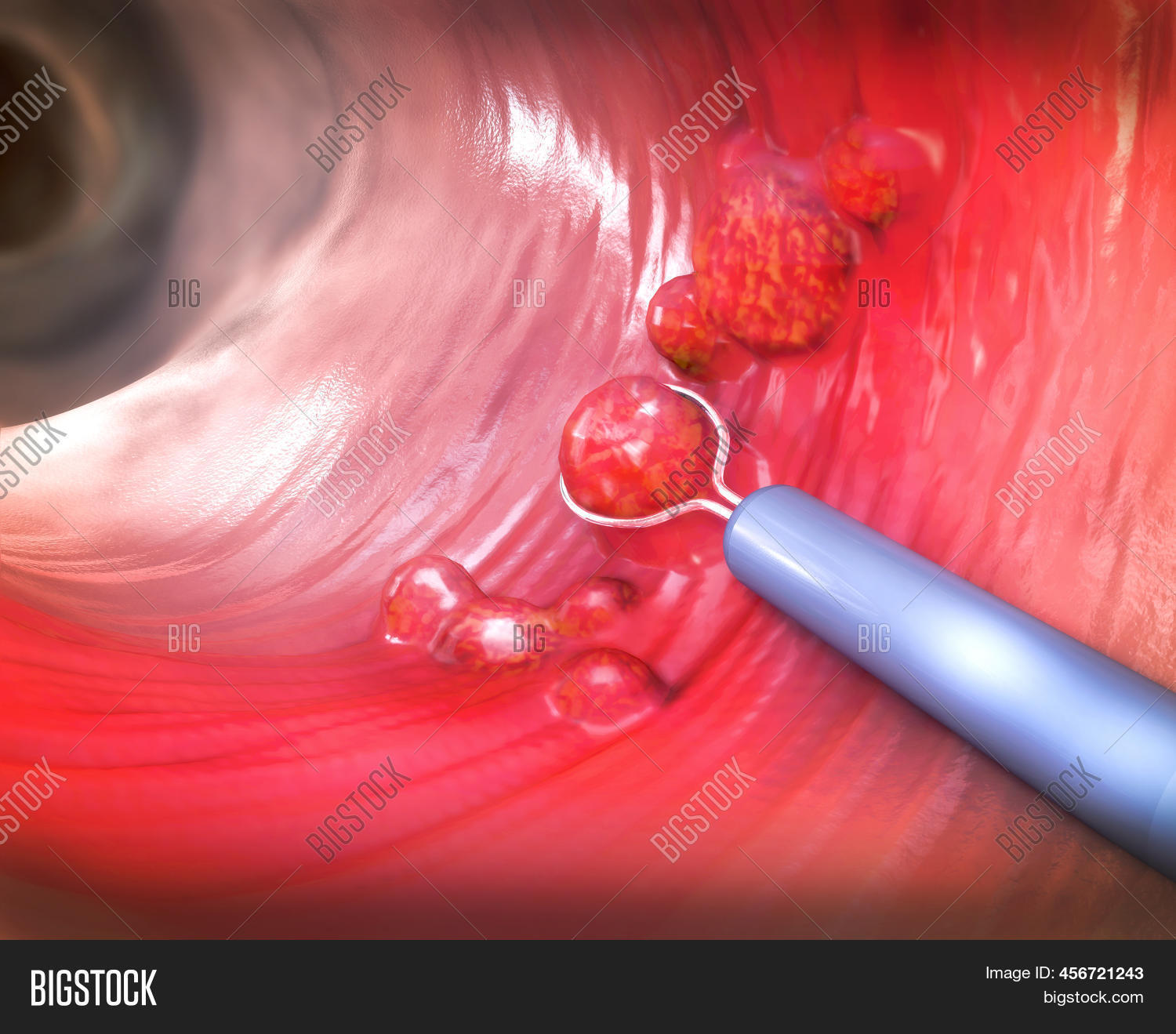 Removal Colonic Polyp Image & Photo (Free Trial) | Bigstock