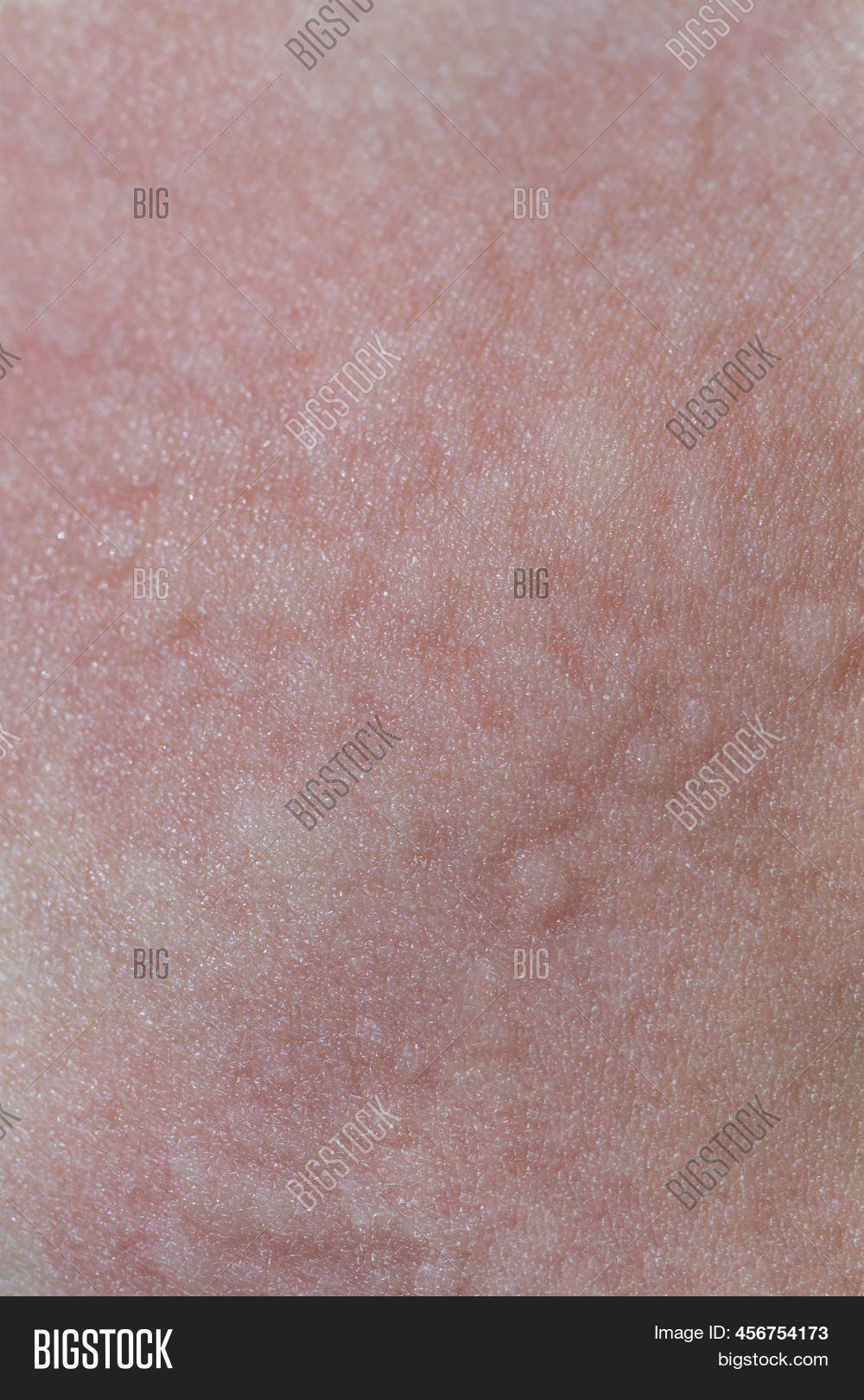 Urticaria On Skin. Red Image & Photo (Free Trial) | Bigstock